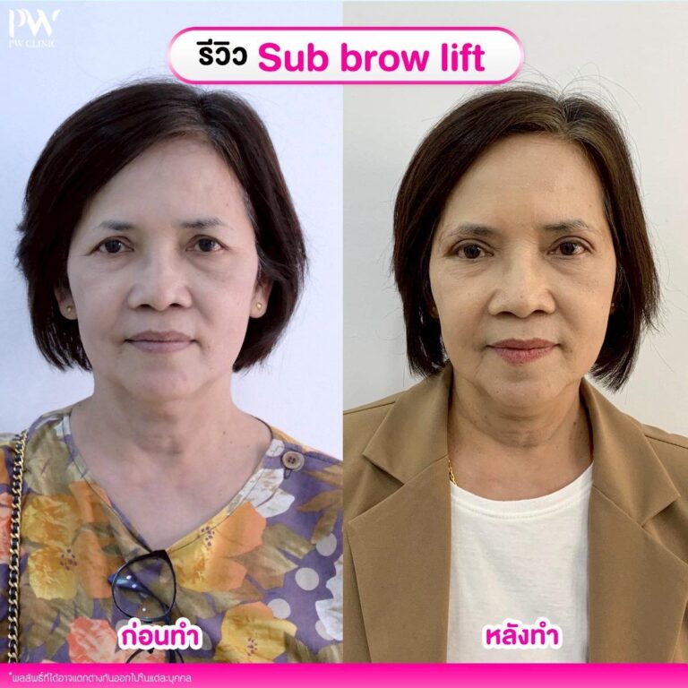 เปิดรีวิว Sub Brow Lift ผ่าตัดยกคิ้วแบบใหม่ แผลน้อย สวยเนียน ไม่หลอกตา ...